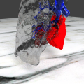 Lung with Pneumonia 3D Model: STL Files for 3D Printing - Lungs ...