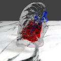 Lung with Pneumonia 3D Model: STL Files for 3D Printing - Lungs ...