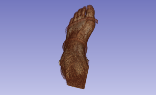 Foot MRI Inversion Internal Rotation Plantar Flexion - Extremity, Lower ...