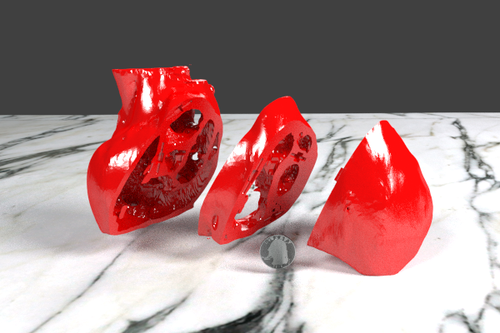 Atrial Septal Defect (ASD) and Mild Coarctation STL Files for 3D ...