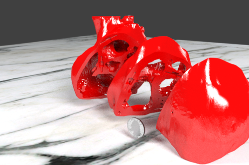 Atrial Septal Defect (ASD) and Mild Coarctation STL Files for 3D ...