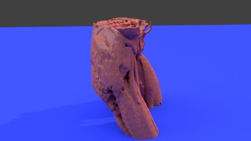 Left thigh sarcoma, a 3D printable medical file converted from a CT ...