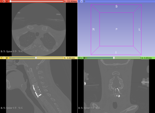 5 neck - Skull, Head, and Neck CTs - embodi3D.com