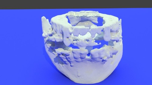 CT maxilla bone - stl file processed - Dental, Orthodontic ...