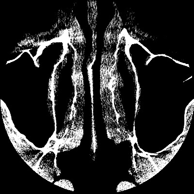 CT maxillary bone with one tooth - Dental, Orthodontic, Maxillofacial ...