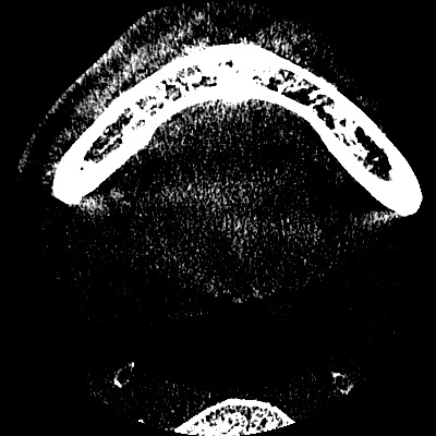 CT mandibula with few teeth - Dental, Orthodontic, Maxillofacial CTs ...