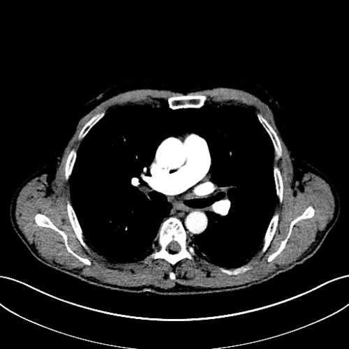Compilation of Chest CT Scans - Thorax CTs - embodi3D.com
