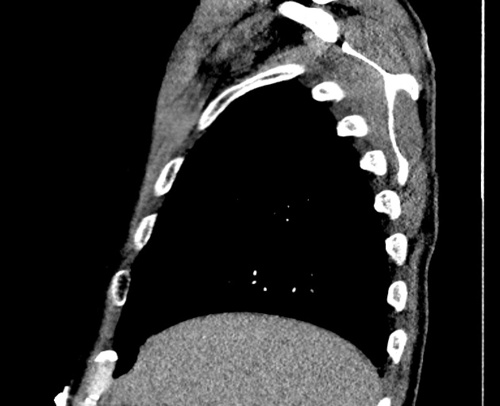 Compilation of Chest CT Scans - Thorax CTs - embodi3D.com