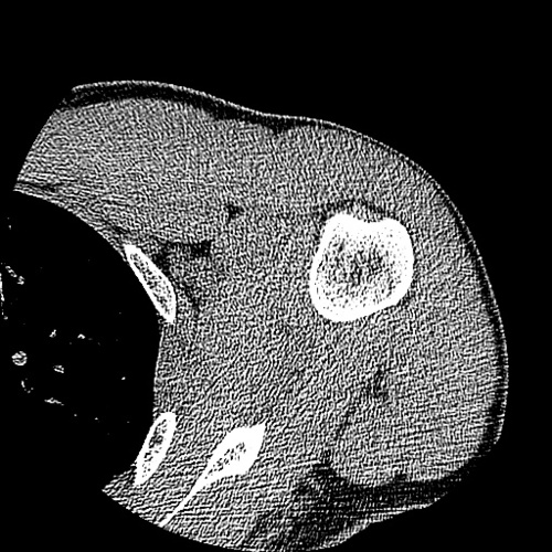 Left Shoulder CT - 6/1/17 - 79mb - Upper Extremity CTs - embodi3D.com