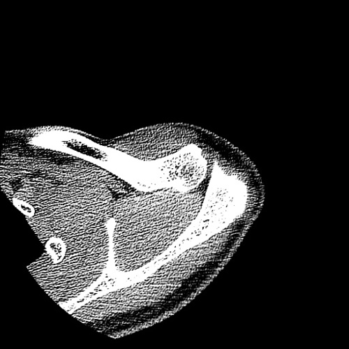 Left Shoulder CT - 6/1/17 - 79mb - Upper Extremity CTs - embodi3D.com