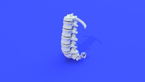CT Scan Spondylolysis - stl file processed - Spine and Pelvis ...