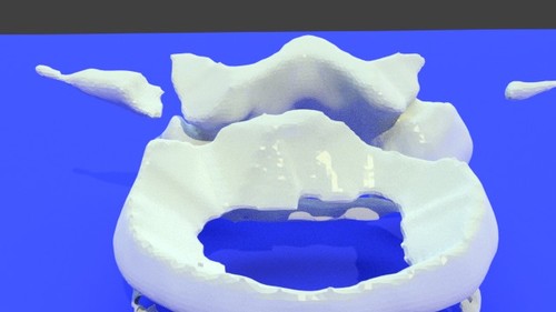 CT Scan Spondylolysis - stl file processed - Spine and Pelvis ...
