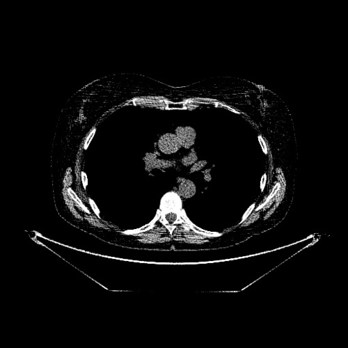 bronchial tree 2 attempt - Thorax CTs - embodi3D.com