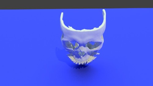 fracture - stl file processed - Dental, Orthodontic, Maxillofacial ...