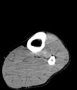 Left Knee Joint CT Scan - Lower Extremity CTs - embodi3D.com