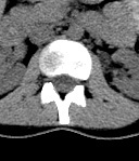 Spinal column (Dorsal, lumbar, Sacral) CT scan - Spine CTs - embodi3D.com