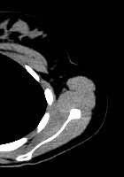 Left Shoulder CT scan - Upper Extremity CTs - embodi3D.com