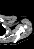 Left Shoulder CT scan - Upper Extremity CTs - embodi3D.com