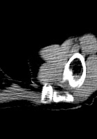 Left Shoulder CT scan - Upper Extremity CTs - embodi3D.com