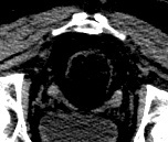 Lumbo-Sacral Spine - CT scan - Spine CTs - embodi3D.com