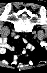 Whole Spine (Cervical-Dorsal-Lumbar-Sacral) - CT scan - Spine CTs ...