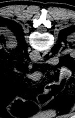 Whole Spine (Cervical-Dorsal-Lumbar-Sacral) - CT scan - Spine CTs ...