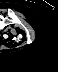 Right Hip - CT scan - Lower Extremity CTs - embodi3D.com