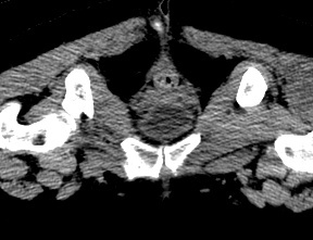 Pelvic Bones (female pelvis) - CT Scan - Abdomen and Pelvis CTs ...