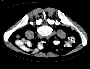 Pelvic Bones (female pelvis) - CT Scan - Abdomen and Pelvis CTs ...