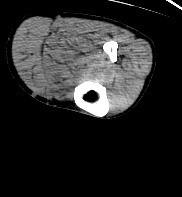 Right knee - CT scan - Lower Extremity CTs - embodi3D.com
