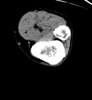 Right knee - CT scan - Lower Extremity CTs - embodi3D.com