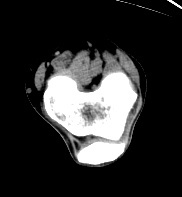 Right knee - CT scan - Lower Extremity CTs - embodi3D.com