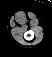 Right knee - CT scan - Lower Extremity CTs - embodi3D.com