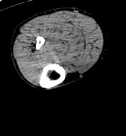 Left knee - CT scan - Lower Extremity CTs - embodi3D.com