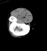Left knee - CT scan - Lower Extremity CTs - embodi3D.com