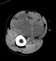 Left knee - CT scan - Lower Extremity CTs - embodi3D.com