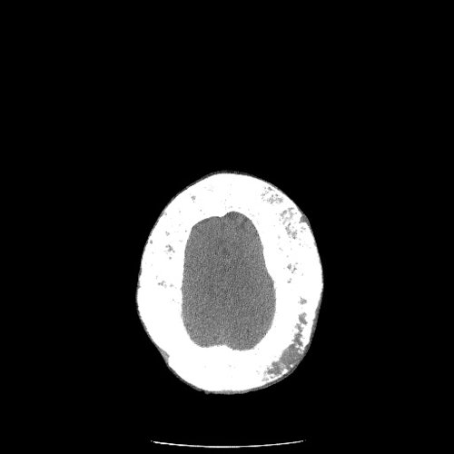 Ossifying Fibroma - Skull, Head, and Neck CTs - embodi3D.com