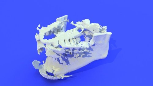 lower wisdom teeth - stl file processed - Dental, Orthodontic ...