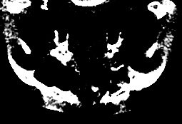 Segmentation.seg.nrrd - Skull, Head, and Neck CTs - embodi3D.com