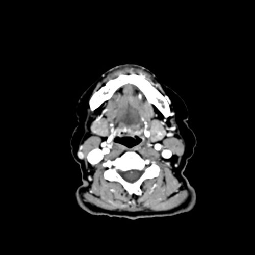 Test CTA neck file - Skull, Head, and Neck CTs - embodi3D.com
