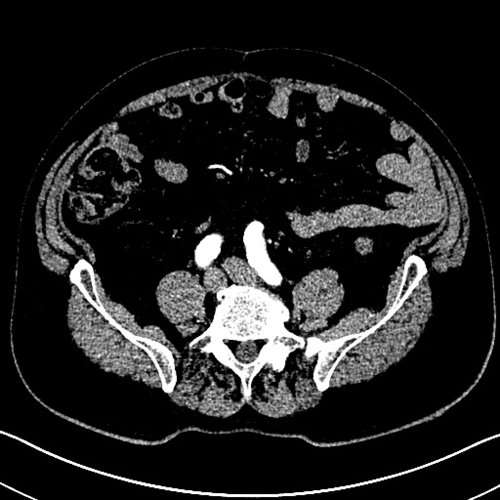 AAA CT - Abdomen and Pelvis CTs - embodi3D.com