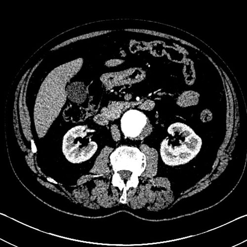 AAA CT - Abdomen and Pelvis CTs - embodi3D.com