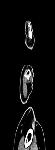 Hand CT scan - Lower Extremity CTs - embodi3D.com