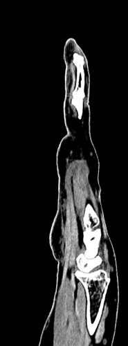 Hand CT scan - Lower Extremity CTs - embodi3D.com