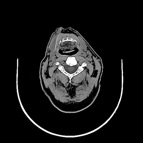 Skull CT Scan - Skull, Head, and Neck CTs - embodi3D.com