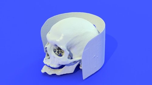 Skull CT Scan - stl file processed - Skull and Face - embodi3D.com