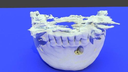 Odontogenic Keratocyst Mandible - stl file processed - Dental ...