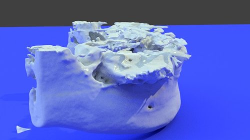Odontogenic Keratocyst Mandible - stl file processed - Dental ...