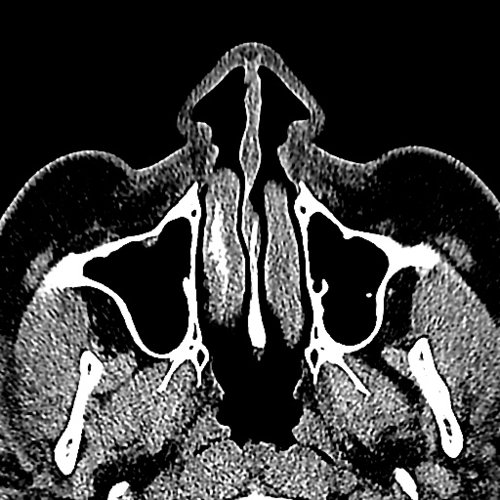 My first CT - Skull, Head, and Neck CTs - embodi3D.com