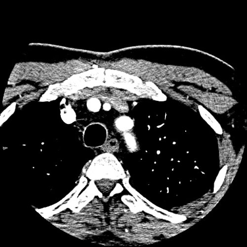 Pulmonary artery sarcoma resected - Heart - embodi3D.com